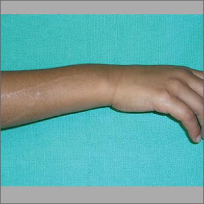 Rash on forearm | MDedge Family Medicine