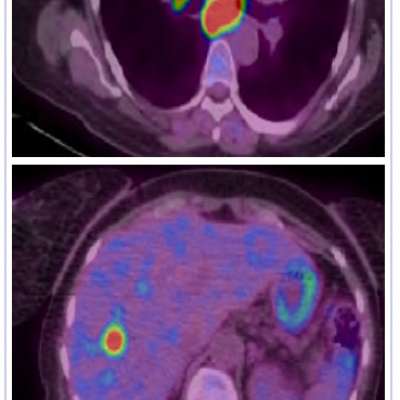 Striking rash in a patient with lung cancer on a checkpoint inhibitor ...