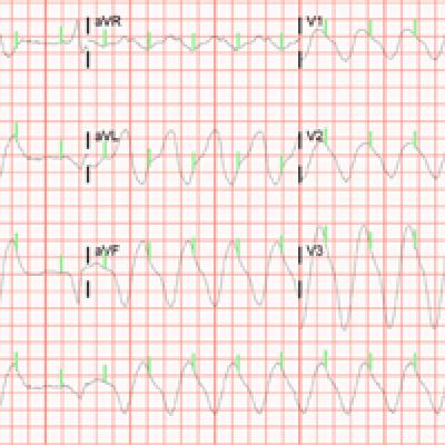 Electrocardiography: Flecainide Toxicity | Clinician Reviews