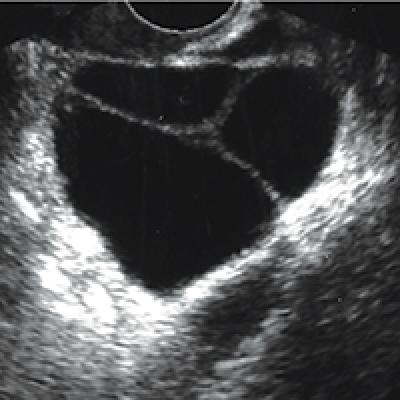 Ovarian masses: Surgery or surveillance? | MDedge ObGyn