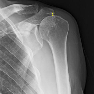 Superior Capsular Reconstruction: Clinical Outcomes After Minimum 2 ...