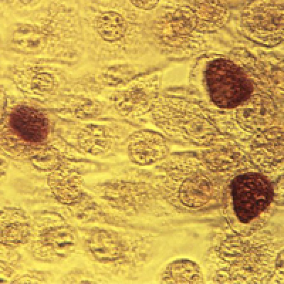 Chlamydia infection: Common, and consequential to women's health ...