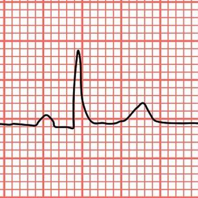 Bradycardia guideline sets new bar for shared decision-making in ...