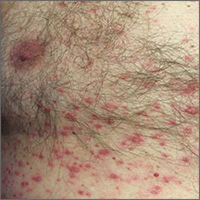 Diffuse skin rash, altered mental status | MDedge Family Medicine
