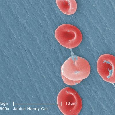 Guidelines cut acute chest syndrome hospital returns in pediatric ...