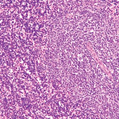 BTK mutations linked to CLL progression on ibrutinib | MDedge ...