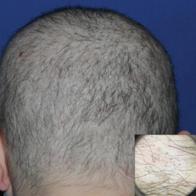 Diffuse Nonscarring Alopecia | MDedge Dermatology