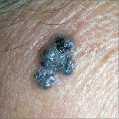 Growth on forehead | MDedge Family Medicine