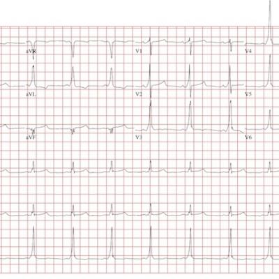 Abrupt Onset Palpitations | Clinician Reviews
