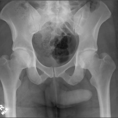 Inmate Falls From Top Bunk | Clinician Reviews