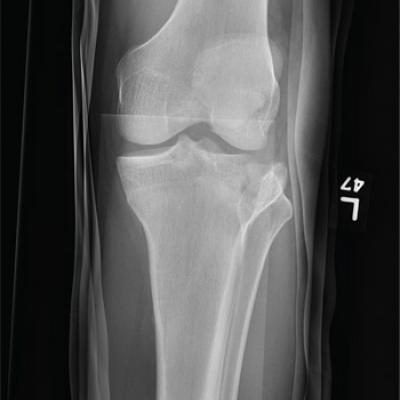 Clipped by an Oncoming Car | Clinician Reviews