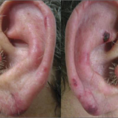 Painful ear nodules | MDedge Family Medicine