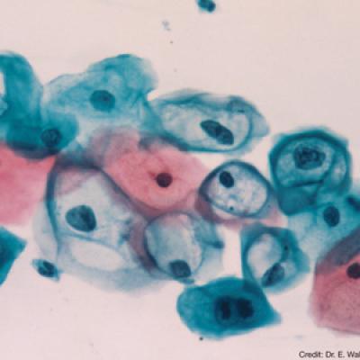 HPV Infection and Cervical Cancer Prevention | Clinician Reviews