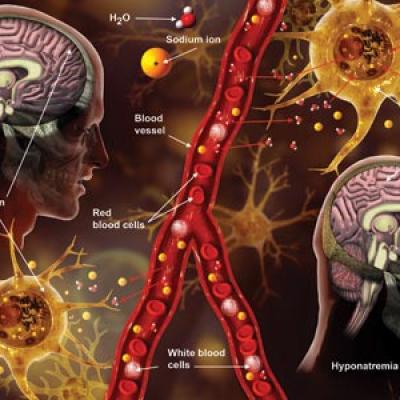 Hyponatremia: Beer Potomania | Clinician Reviews