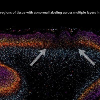 Autism starts in utero, brain tissue study indicates | MDedge Family ...