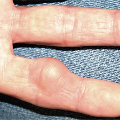 Growing Lesion Impedes Finger Flexion | Clinician Reviews