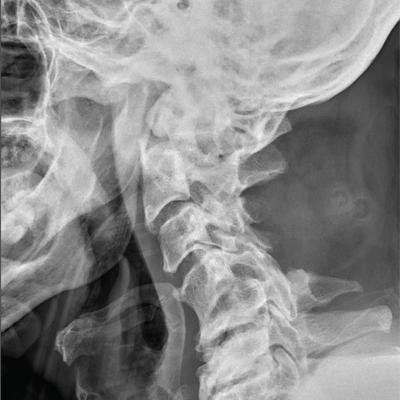 Neck Pain With No Palpable Tenderness | Clinician Reviews