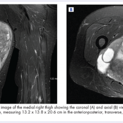 Management of high-grade pleomorphic sarcoma with colon metastasis ...