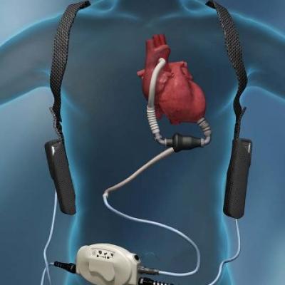 LVADs for Severe Heart Failure Gradually Take Hold | MDedge Internal ...