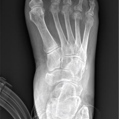 Foot Pain Following a Car Crash | Clinician Reviews
