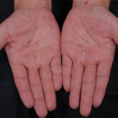 Atypical Presentation of Secondary Syphilis | MDedge Dermatology