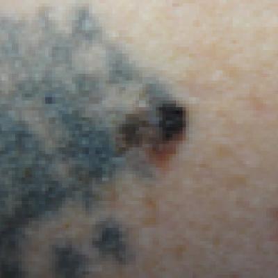 Rare Cancer Tattoos