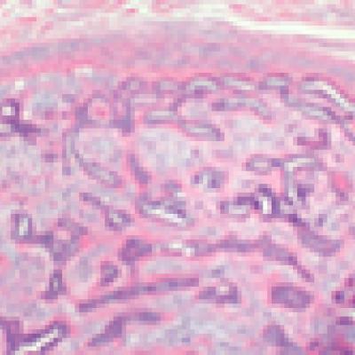 Chondroid Syringoma | MDedge Dermatology