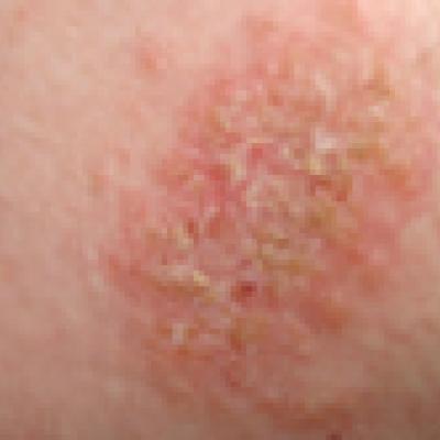 A Prolonged Incubation Period in Zosteriform Leishmania panamensis ...