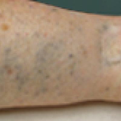 Localized Diffuse Melanosis Associated With Melanoma Successfully ...