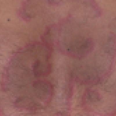 What Is Your Diagnosis? Subacute Cutaneous Lupus Erythematosus | MDedge ...