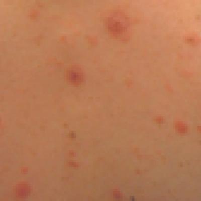 What Is Your Diagnosis? Secondary Syphilis | MDedge Dermatology