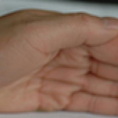 Plaques: A Rare Presentation of Acrokeratoelastoidosis | MDedge Dermatology