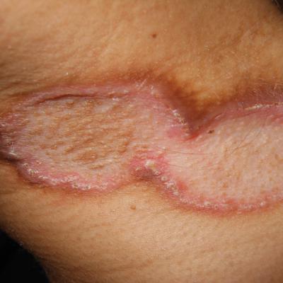 Asymptomatic Annular Plaques on the Neck | MDedge Dermatology