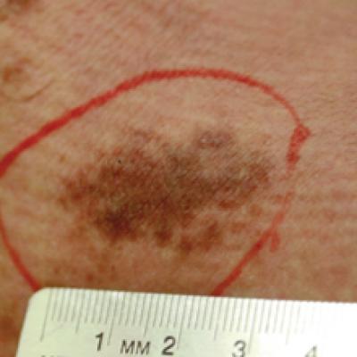 Hyperpigmented Patch on the Leg | MDedge Dermatology
