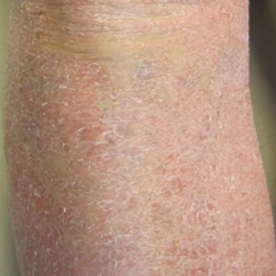 Pityriasis Rubra Pilaris and Severe Hypereosinophilia | MDedge Dermatology