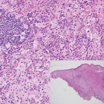 Orange Nodules on the Scalp | MDedge Dermatology