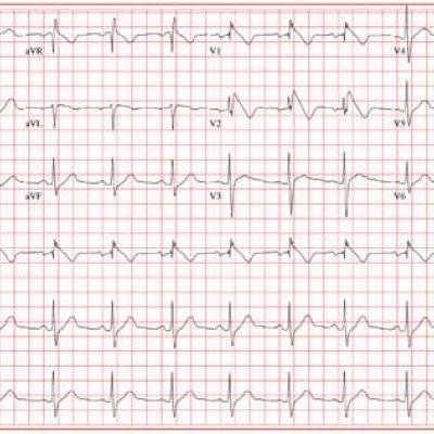 Should This Man be Worried About Sudden Death? | Clinician Reviews