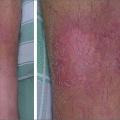 Erythematous plaque with yellowish papules on the shin | MDedge Family ...