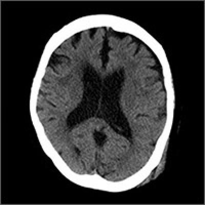 Confusion recurs 2 weeks after fall | MDedge Family Medicine