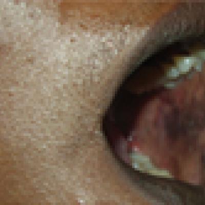 Addisonian Pigmentation and Vitamin B12 Deficiency: A Case Series and ...