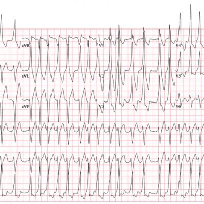 Basketball Player with Continuous Palpitations | Clinician Reviews