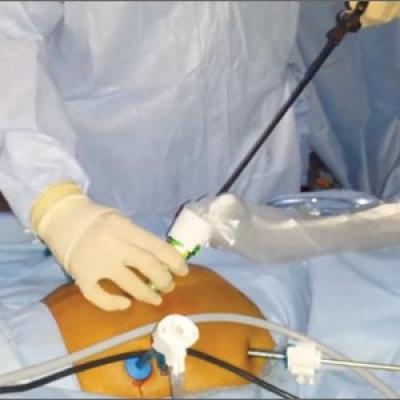 Laparoscopic dual-port contained power morcellation: An offered ...