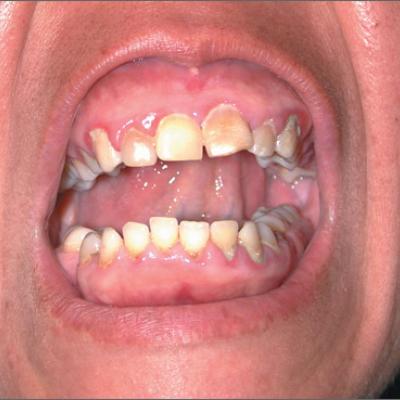Enlarged gums | MDedge Family Medicine