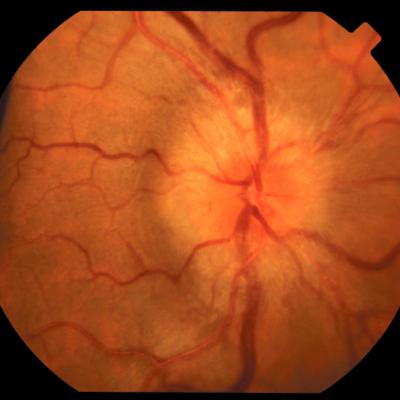 Papilledema Mri