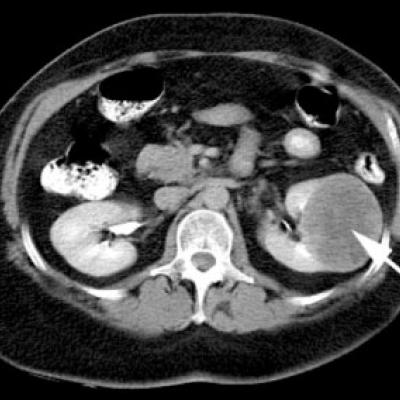 Left-sided flank pain | MDedge Family Medicine