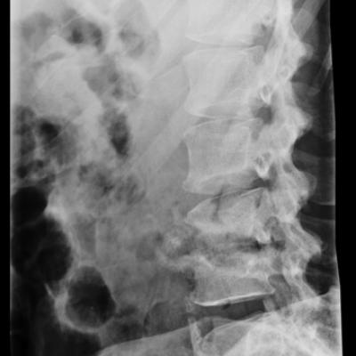 Man with Debilitating Back Pain | Clinician Reviews