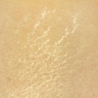 Interventions for the Treatment of Stretch Marks: A Systematic Review ...