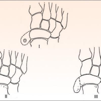 Surgical Treatment of Symptomatic Accessory Navicular in Children and ...