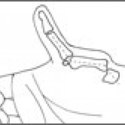 Volar Plate Capsulodesis for Metacarpophalangeal Hyperextension With ...
