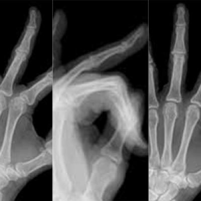 Flexion Deformity of the Fifth Digit | MDedge Emergency Medicine